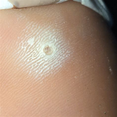 Is This A Corn Or A Wart R Warts