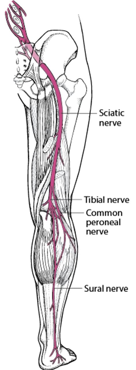 Image Sciatica Msd Manual Consumer Version