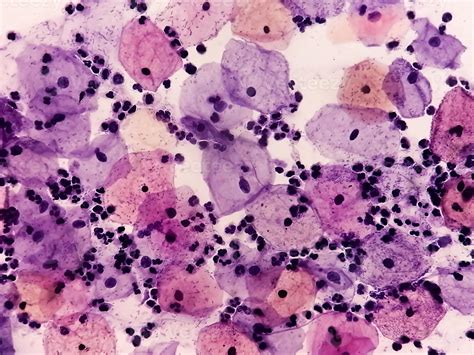 Microscopic View Of Paps Smear Showing Severe Negative For Intraepithelial Lesion Malignancy Or
