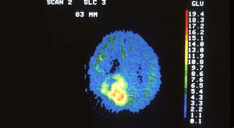 Brain Tumor Groups Come Together For New Imaging Effort News Blog National Brain Tumor Society
