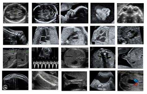 E2 Ecografía morfológica detallada con screening de parto prematuro