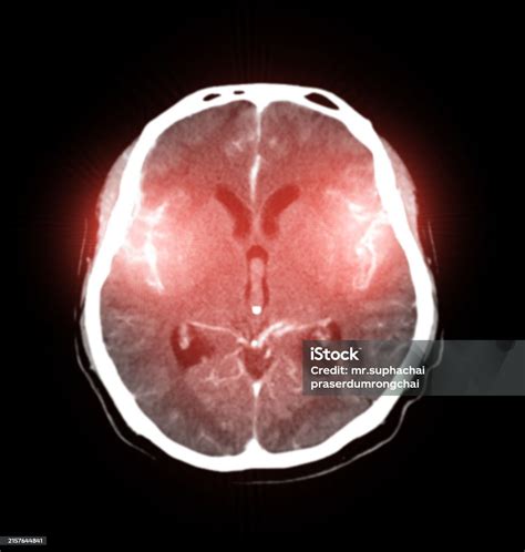 A Ct Brain Scan Reveals A Subarachnoid Hemorrhage With Clear Signs Of