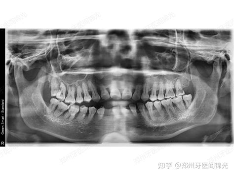 中年女性凸面形伴前牙重度开合中度牙周炎的固定矫治设计 知乎