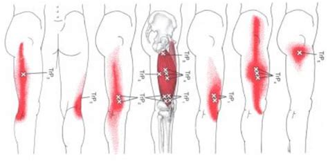 Dry Needling For Hip And Knee Pain — On Track Physiotherapy