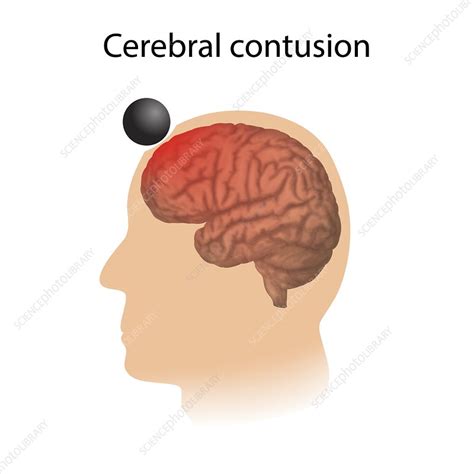 Cerebral Contusion Illustration Stock Image F0327794 Science