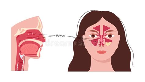 Nasal Polyps Poster Stock Illustration Illustration Of Swelling 398119737