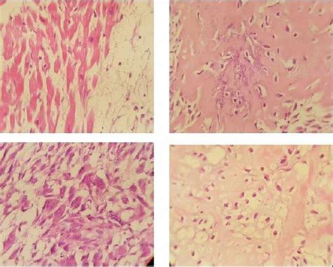Pathologic Studies Proliferation Of Neoplastic Spindle Shaped