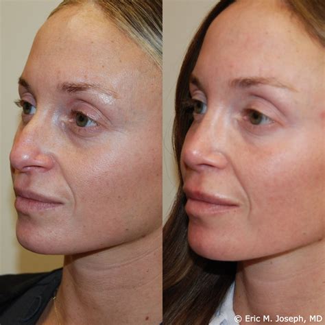 Eric M Joseph Md Rhinoplasty Before And After Septoplasty And Hump