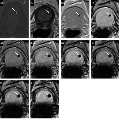 An Example Of Challenging Differentiation Between Gold Fiducial Markers Download Scientific