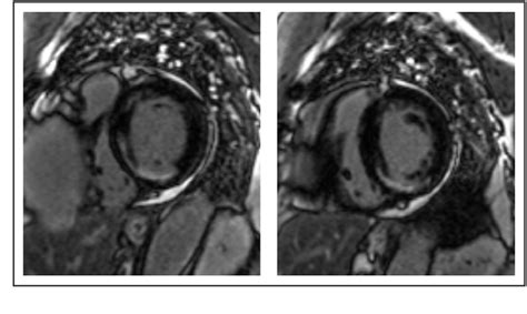 Figure 2 From Left Upper Extremity Pain Right Coronary Artery Culprit