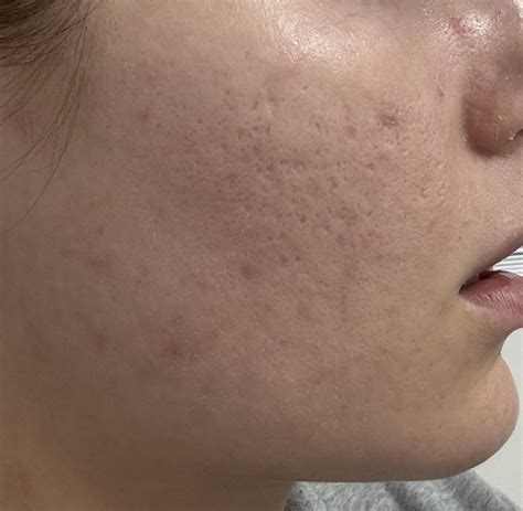 Holes In Face Rskincareaddiction