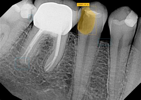 dexis announces clearance of artificial intelligence findings on 2d