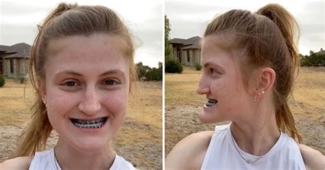 The Case When Plastic Surgery Was Super Necessary The Girl With A Severely Protruding Lower Jaw