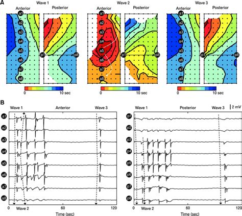 A Dysrhythmic And Tachygastria Episode Of Gastric Slow Waves During Download Scientific Diagram