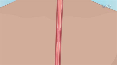 Video Esophageal Strictures I Introduction