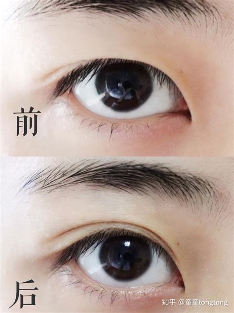 怎么从单眼皮自然变成双眼皮？ 知乎