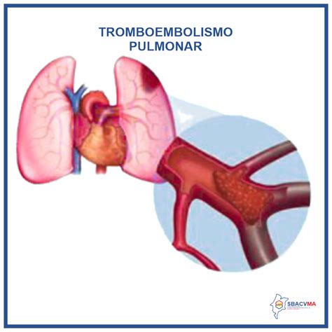 Tromboembolismo Pulmonar (TEP) - SBACVMA