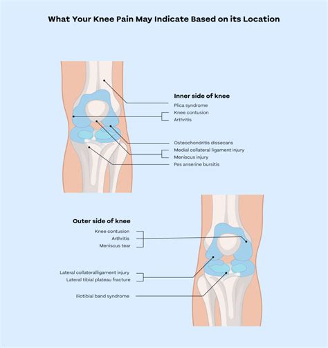 Knee Pain Location Chart Understanding Inner Knee Pain