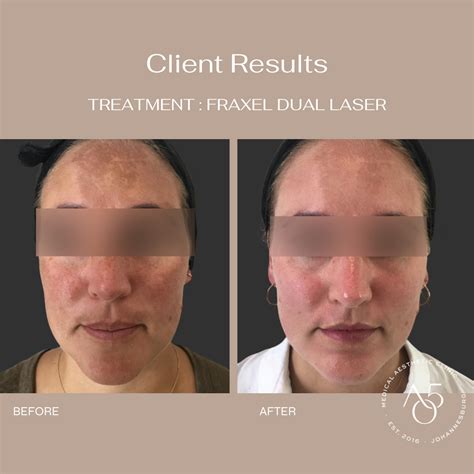 Results From Fraxel Dual Laser Fraxel Aesthetics On 5th