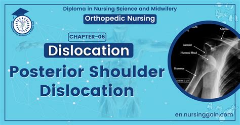 Posterior Shoulder Dislocation Chapter 6 Orthopedic Nursing