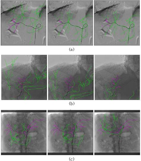 Figure 1 From Locally Adaptive 2d 3d Registration Using Vascular
