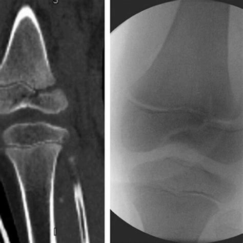 Delbet Type Iii Fracture Anatomically Reduced And Stabilised With A