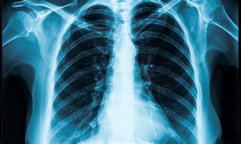Ai Predicts Heart Disease Risk From Single X Ray