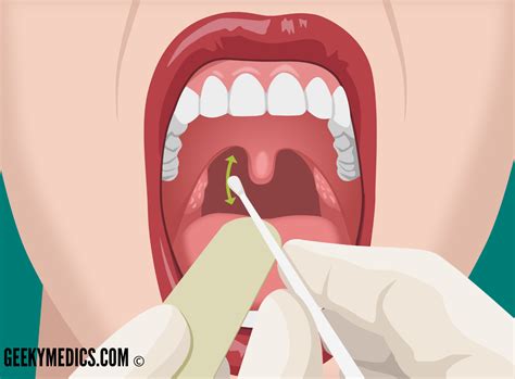 Oropharyngeal Swab Osce Guide Geeky Medics
