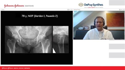 Femoral Neck System Fns Depuy Synthes