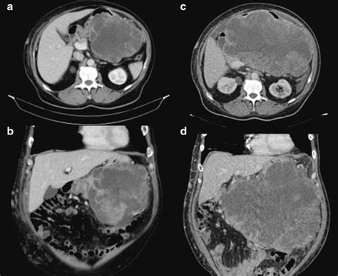 Giant Gastric Gastrointestinal Stromal Tumor Gist Springerlink