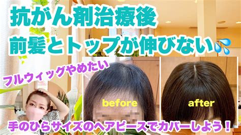 抗がん剤治療後の発毛、前髪やトップが伸びない！？