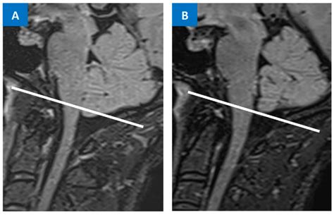 Flair Sequence Mri Showing Low Lying Cerebellar Tonsils Which Can Lead Download Scientific