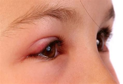 ViÊm BỜ Mi TrÊn MẮt NguyÊn NhÂn TriỆu ChỨng VÀ PhÒng NgỪa Doctor