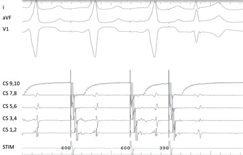 Electrogram Interpretation 13 Ep Essentials