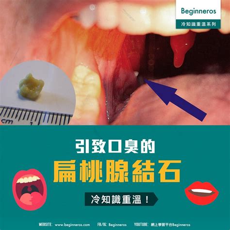【健康冷知識】引致口臭的扁桃腺結石 Beginneros 網上學習平台
