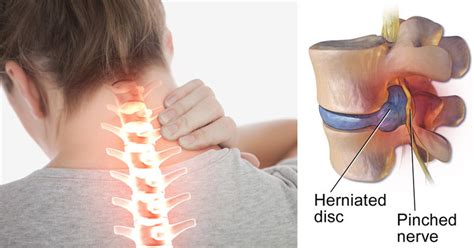 7 Easy To Miss Signs Of A Slipped Disc And How To Fix It