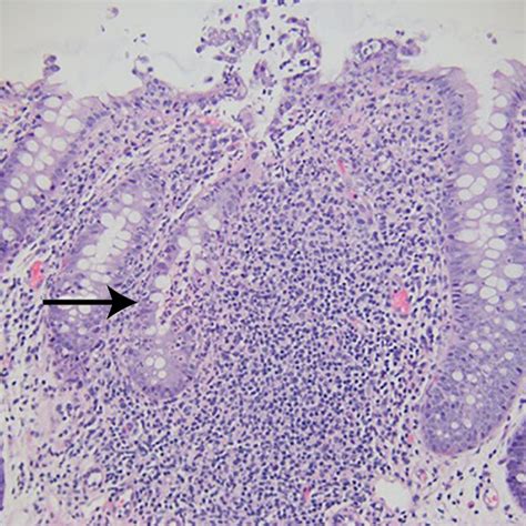 Biopsy Specimens Of The Rectum Sigmoid And Descending Transverse