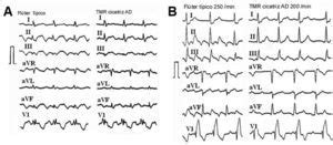 Flúter auricular perspectiva clínica actual Revista Española de Cardiología