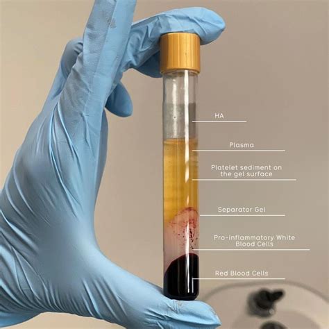 How Natural Treatments Like Prp Benefit Your Clinic Regenlab Uk Posted On The Topic Linkedin