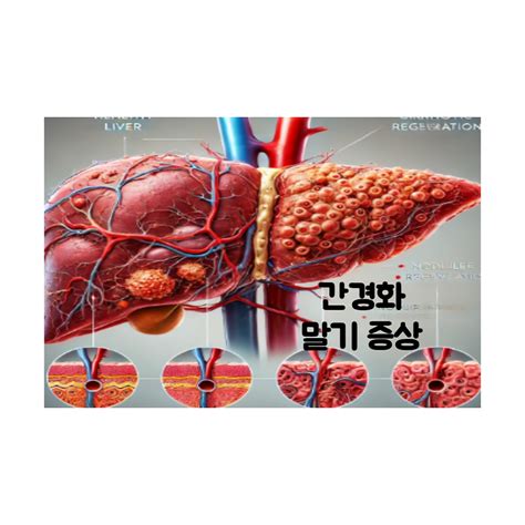 간경화 말기증상과 관리방법