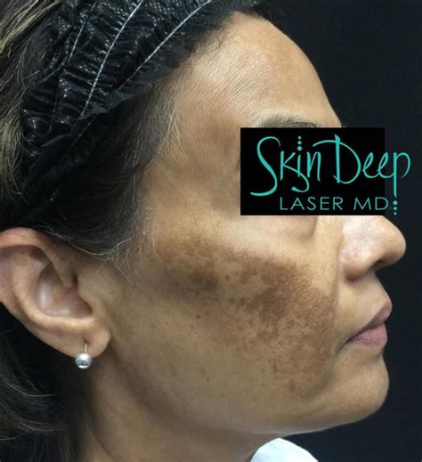 Melasma Skin Deep Laser Md