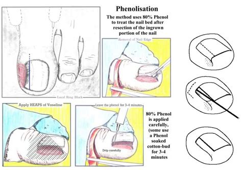 Toenail Removal Matrixectomy At Marcia Reames Blog