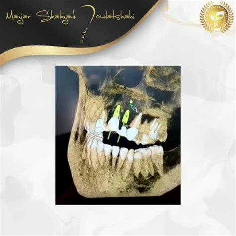 Dr Maziar Shahzad Dowlatshahi On Linkedin Surgery