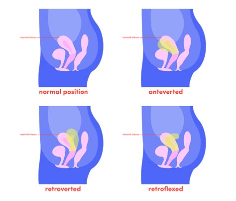 Normal Uterus And Tilted Uterus Best Menstrual Cup For A Tilted Uterus
