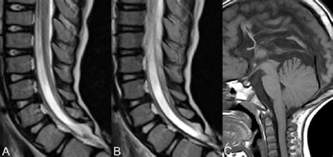腰椎先天性异常磁共振诊断要点 知乎