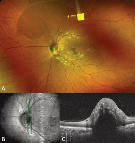 What Is Chrpe Eye At Greg Booth Blog