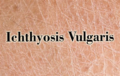 Ichthyosis Scoring System Powerful Tool To Measure Global Ichthyosis Severity Jama