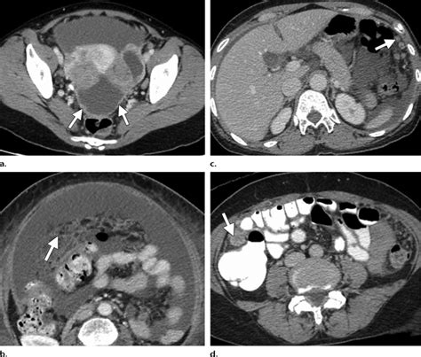 Axial Contrast Enhanced Ct Images Show Various Morphologic Patterns Of