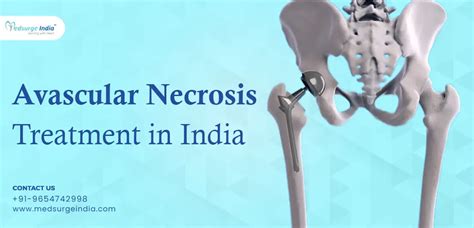 Avascular Necrosis Treatment Cost In India Medsurge India