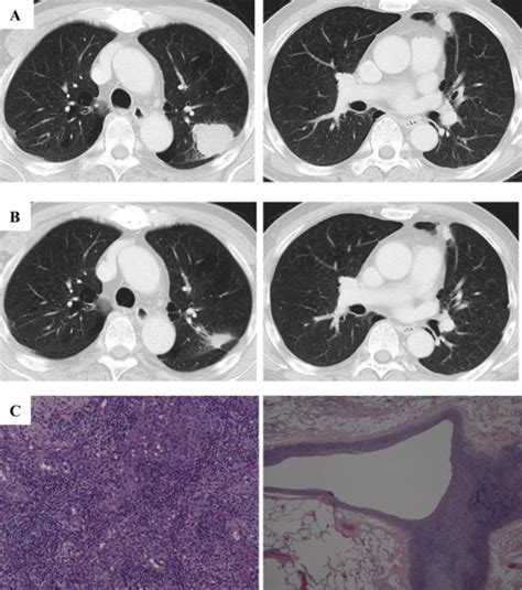 Radiological Evaluation By Ct A Before Treatment A 38 Mm Tumor In